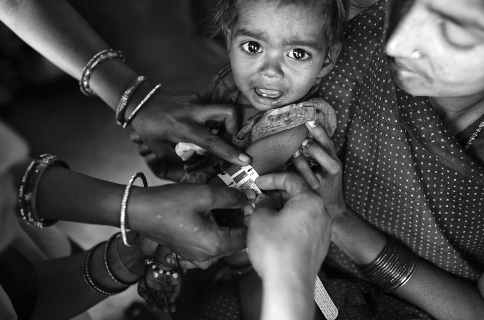 Child Malnutrition in India – Angel Navarrete